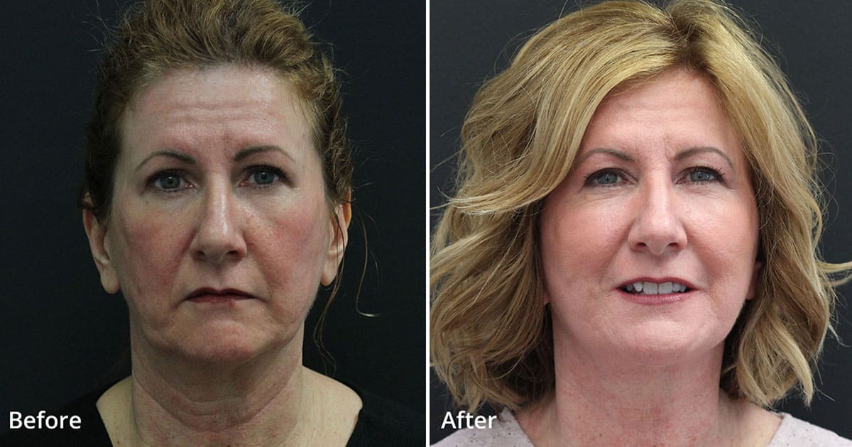 Facial Fat Grafting New Jersey & Philly | Becker Plastic Surgery
