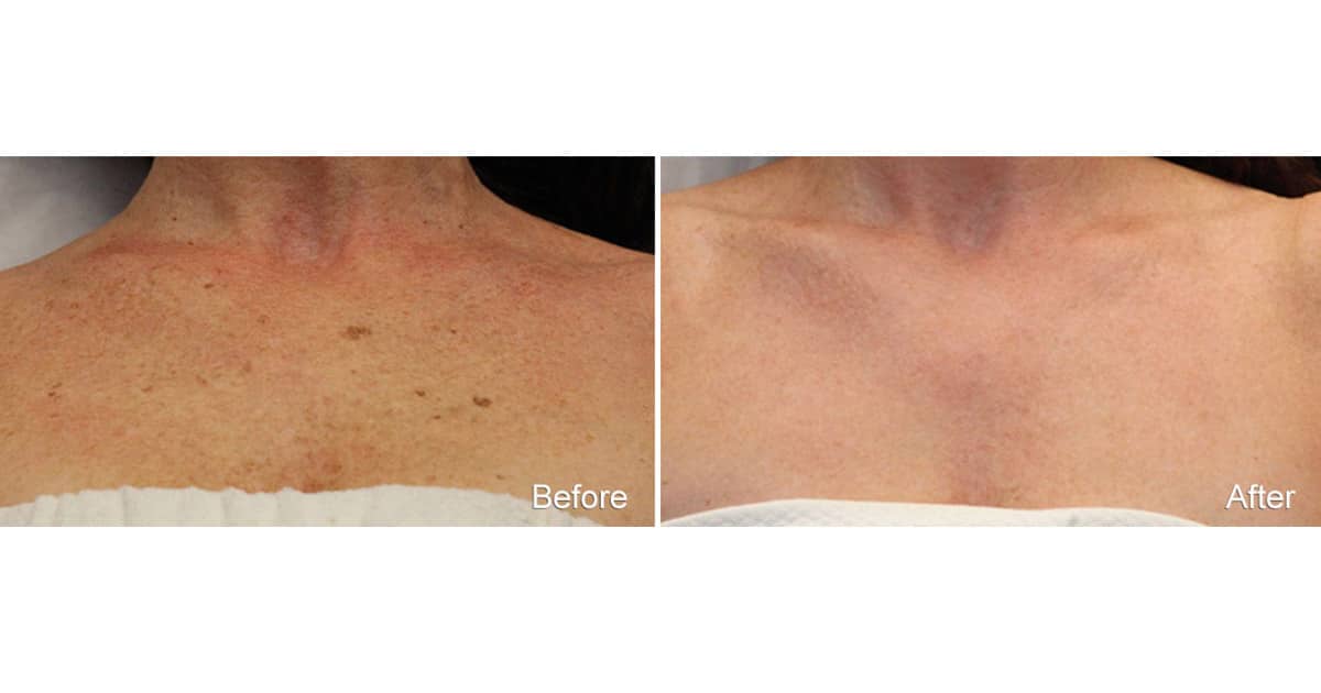 Laser Resurfacing New Jersey And Philadelphia Dr Becker