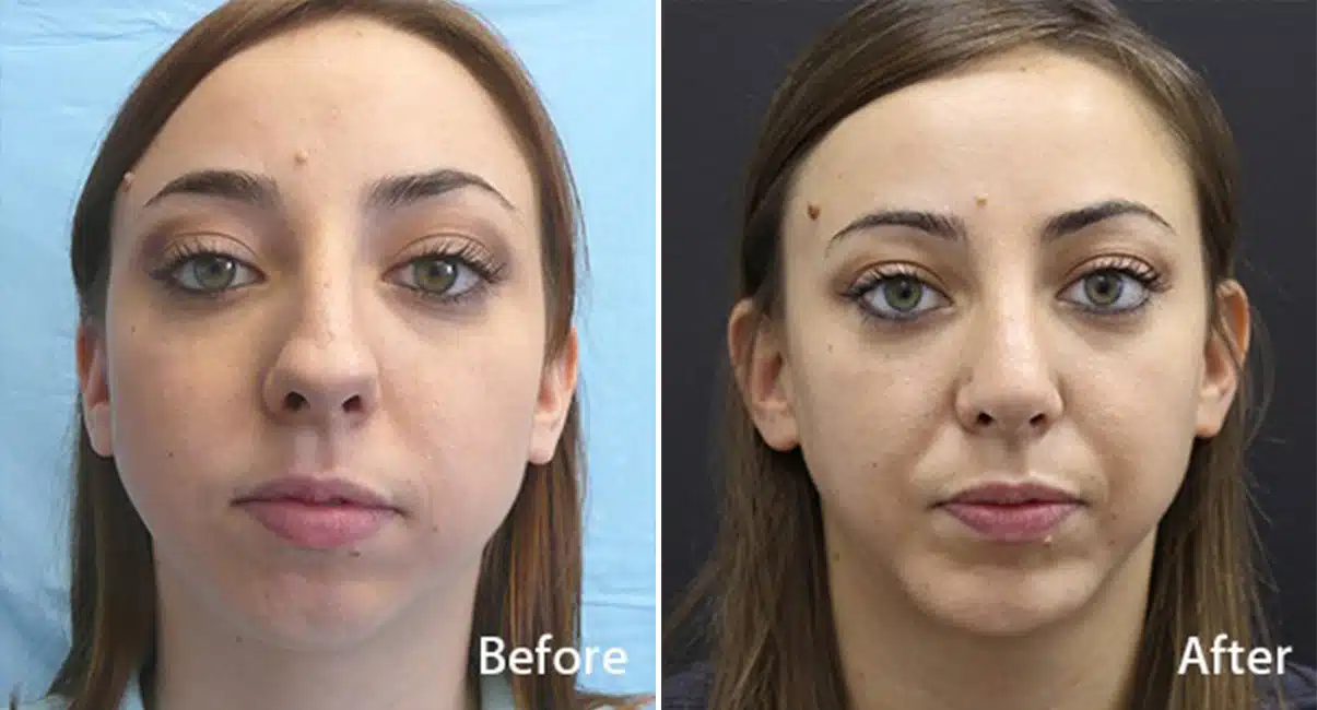 Chin Implants New Jersey & Philly | Becker Plastic Surgery