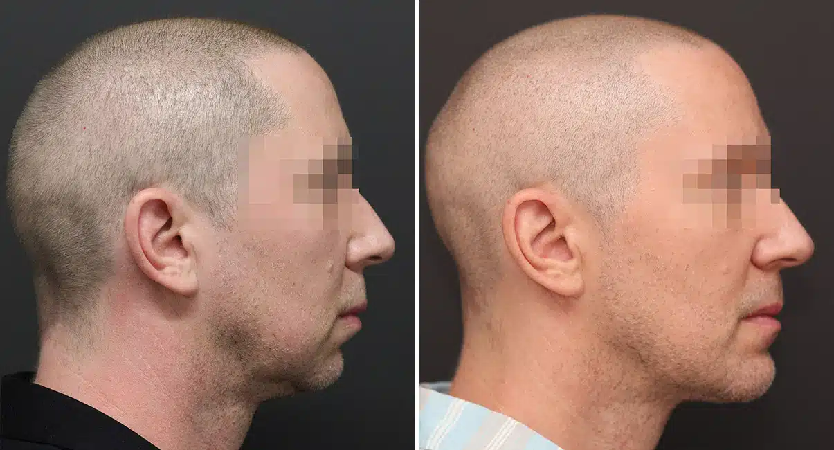 How to Determine the Ideal Chin Implant Shape for Your Facial Aesthetics