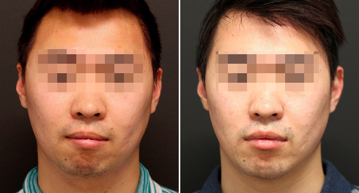 Chin Implants New Jersey & Philly | Becker Plastic Surgery