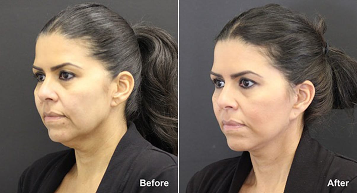 Fractional Laser Neck Lift: A Non-Invasive Solution for Sagging Skin