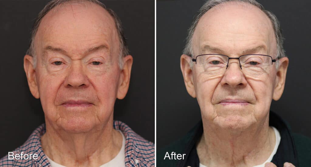 Effective Neck Lift Scar Management Techniques