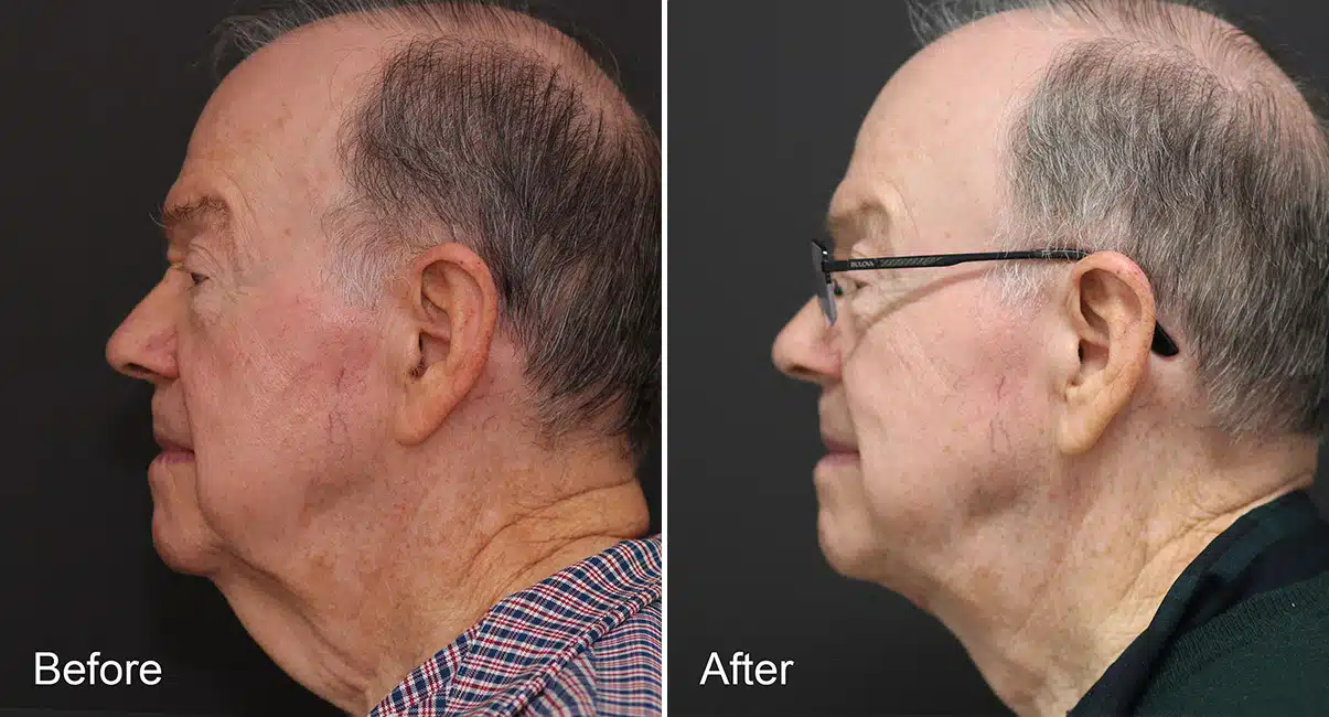 Understanding the Cost of Neck Lift Surgery: What to Expect