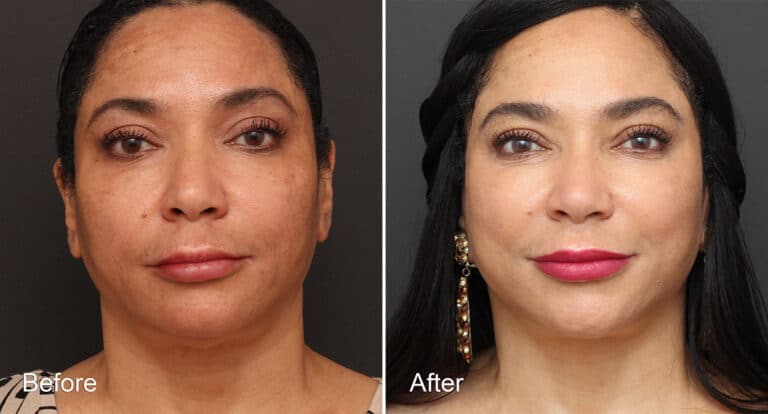 Neck Lift Recovery Timeline: Managing Post-Surgery Expectations