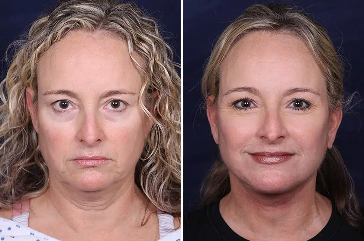 Facelift at 30: Why More People are Opting for One