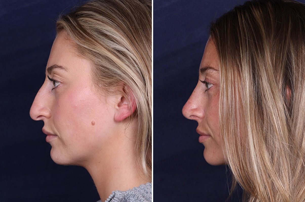 Rhinoplasty Photos | Philadelphia, PA | Patient 4098