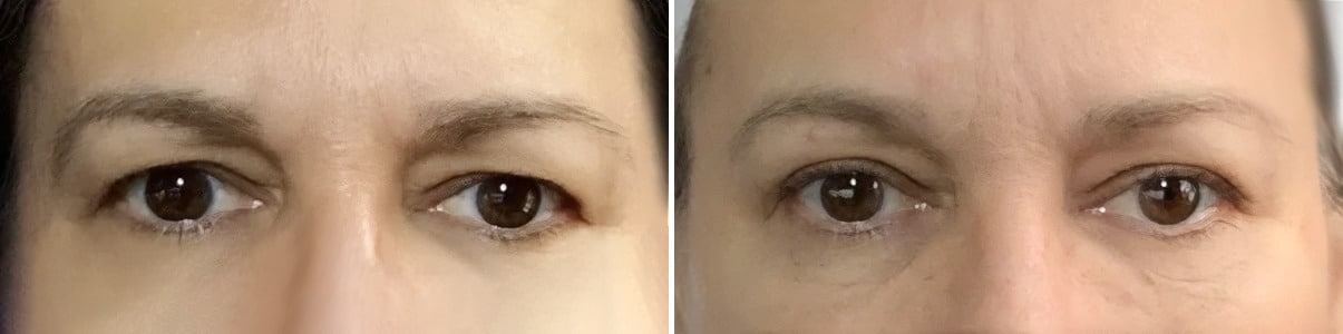 How Blepharoplasty Can Improve Uneven Eyelids