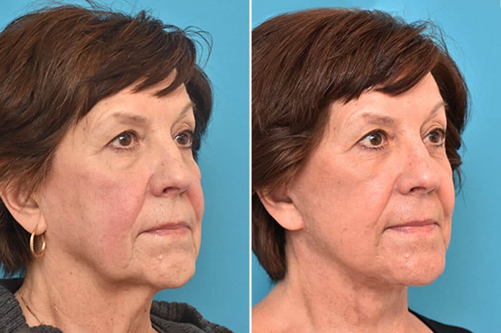 Facelift Recovery Guide: Essential Tips on Post-Surgery Care