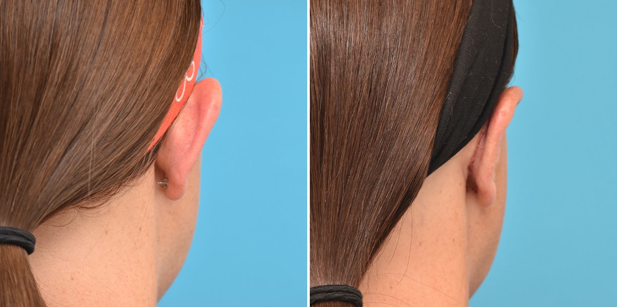 Otoplasty Recovery: Tips for a Smooth Healing Process