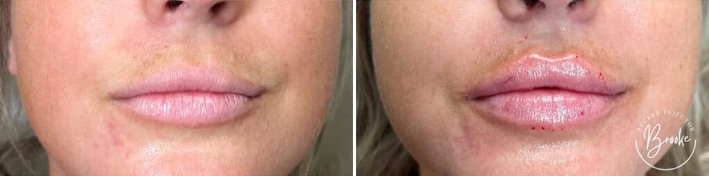 Get Fuller and Beautiful Lips with Juvederm Volbella