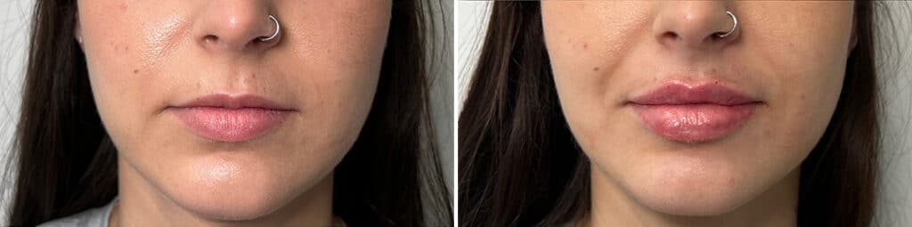 Get Fuller and Beautiful Lips with Juvederm Volbella