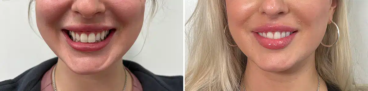 Botox and Jowls: Can Botox Injections Cause Sagging?