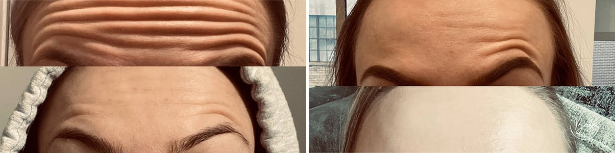 Tips for Managing Hematoma/Bruising After Botox Injections