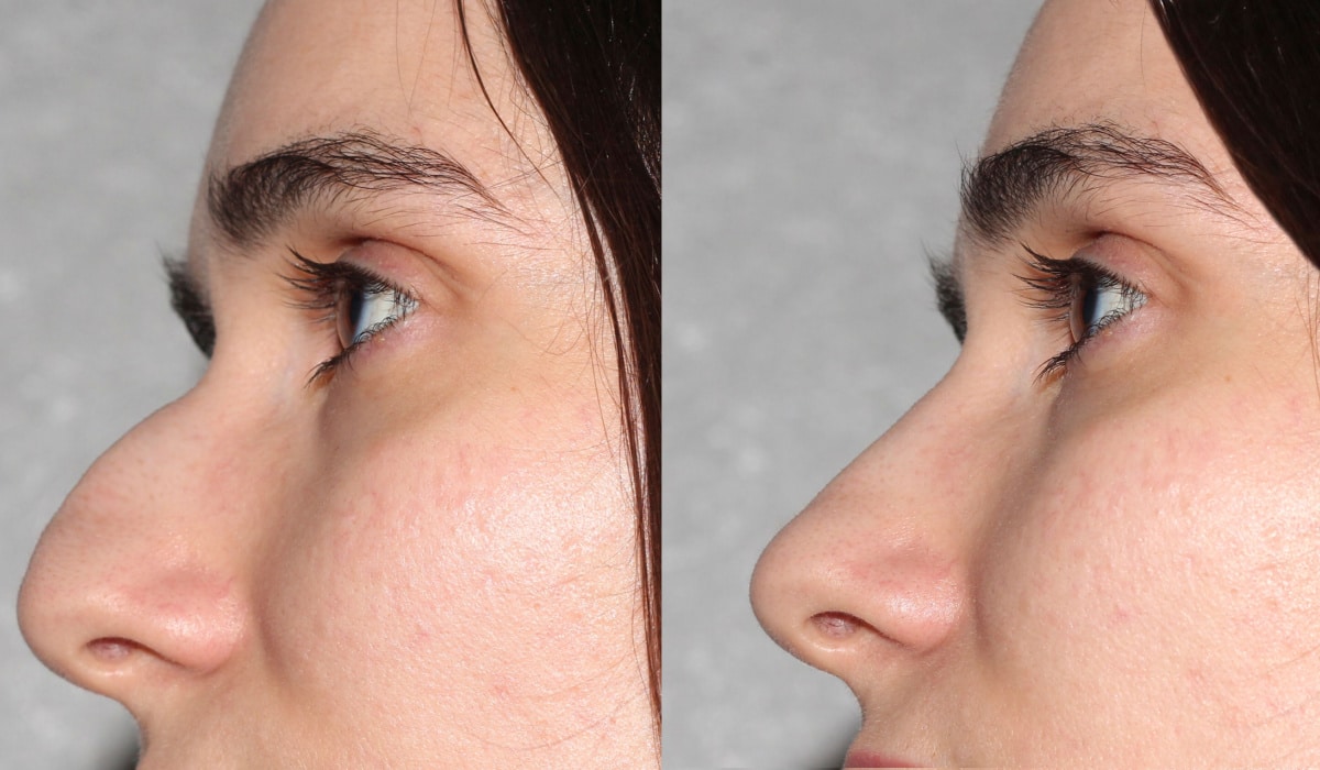 Expert Rhinoplasty Guide: Techniques, Benefits & Care