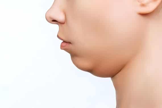 How to Determine the Ideal Chin Implant Shape for Your Facial Aesthetics