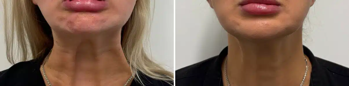 Botox and Jowls: Can Botox Injections Cause Sagging?