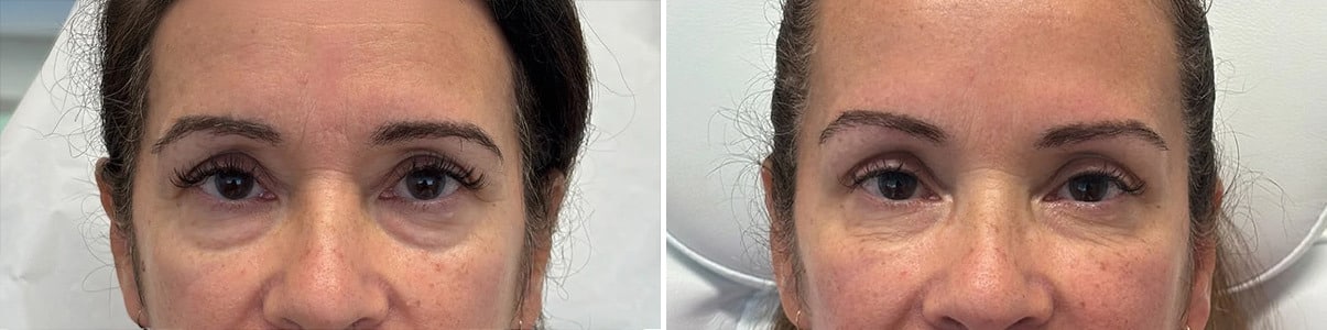 6 Benefits of Micro Botox for Under-Eye Rejuvenation